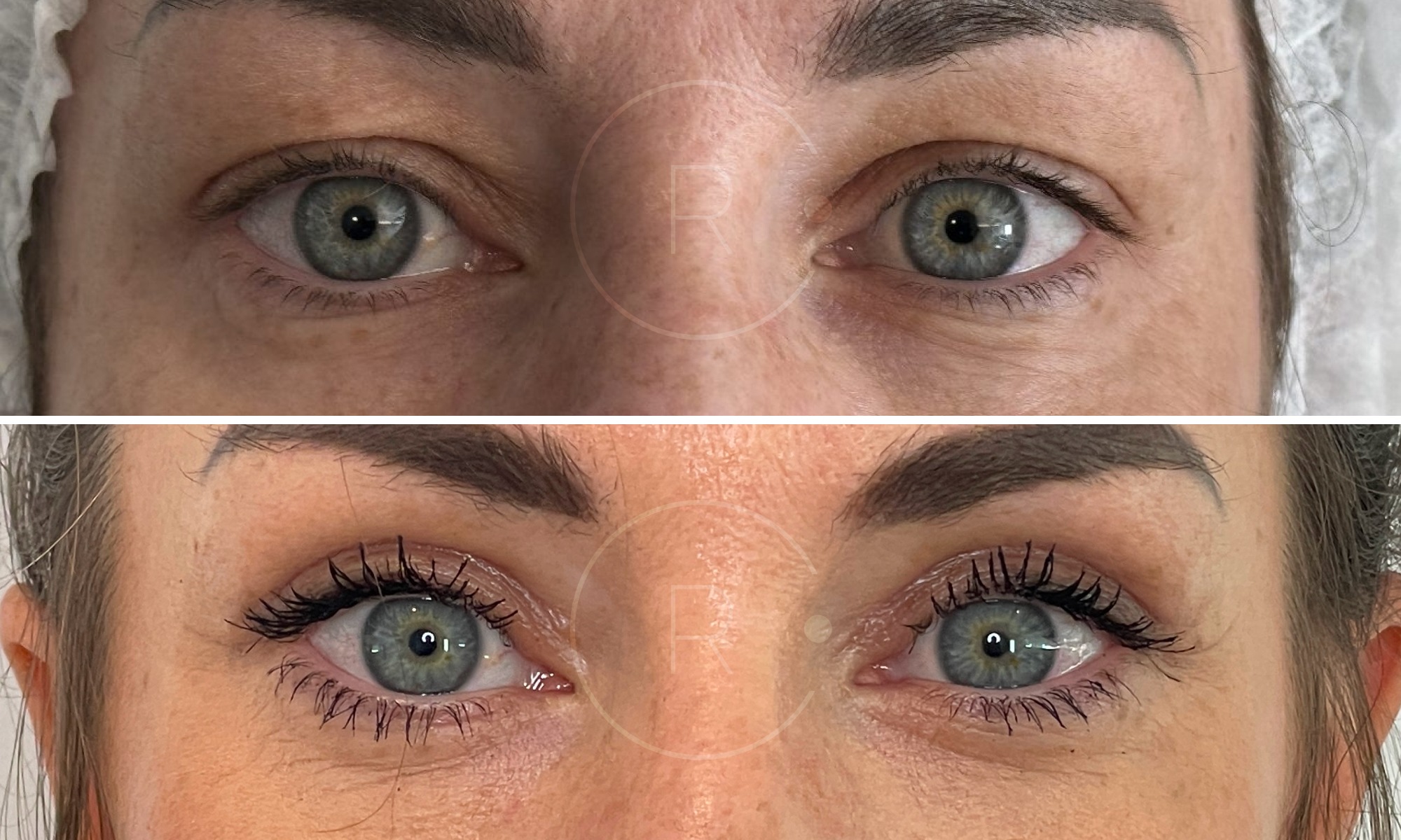 Avant/après : Blépharoplastie à Lyon | Dr Christophe Reinbold