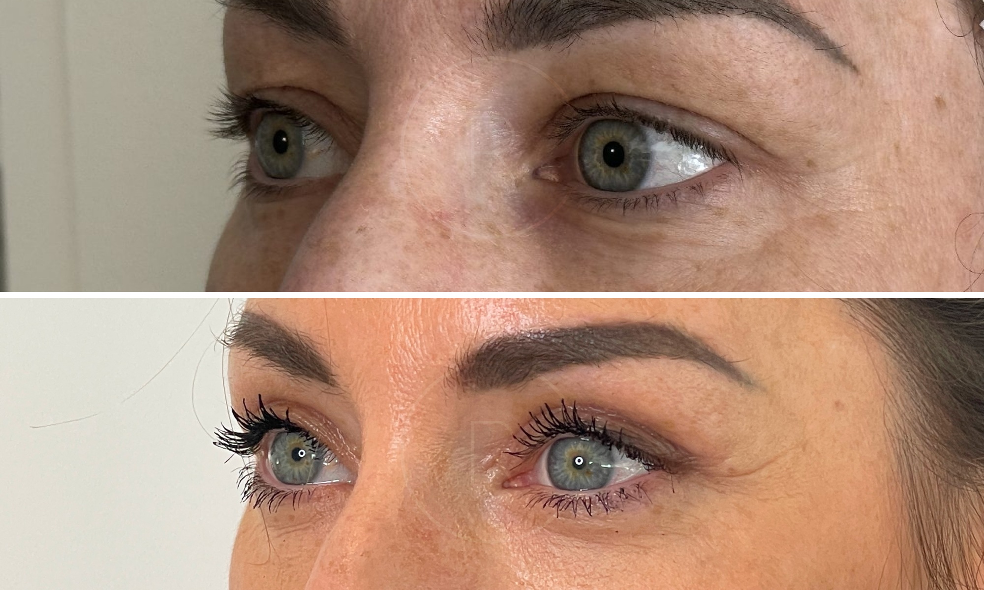 Avant/après : Blépharoplastie à Lyon | Dr Christophe Reinbold