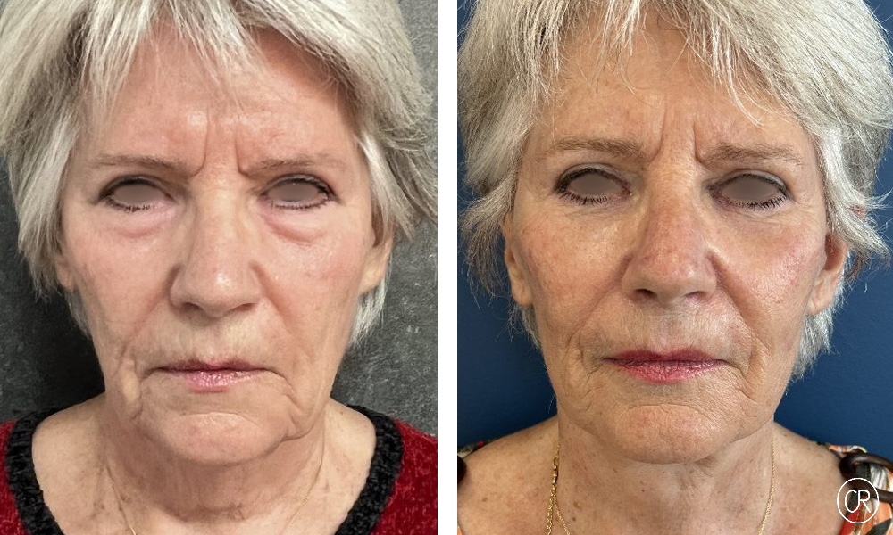 Lifting visage et cou à Lyon | Chirurgie esthétique | Dr Reinbold | Lyon